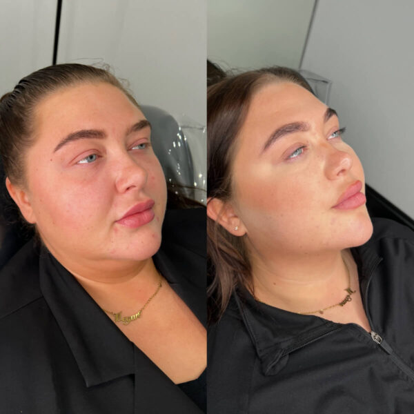 Fat Dissolving | Fat Dissolving Services | Faces By Bae