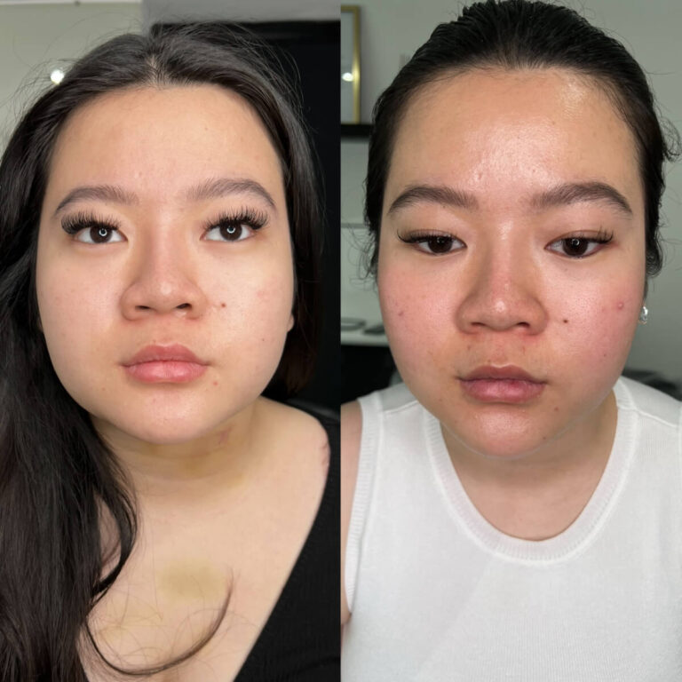 Masseter Jawline Slimming Botox - Faces By Bae