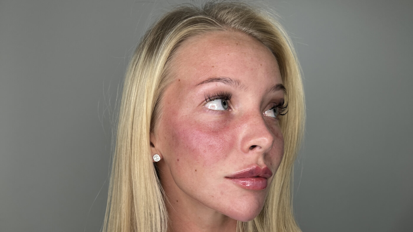 Cheek Filler for Volume & Contour | Faces By Bae