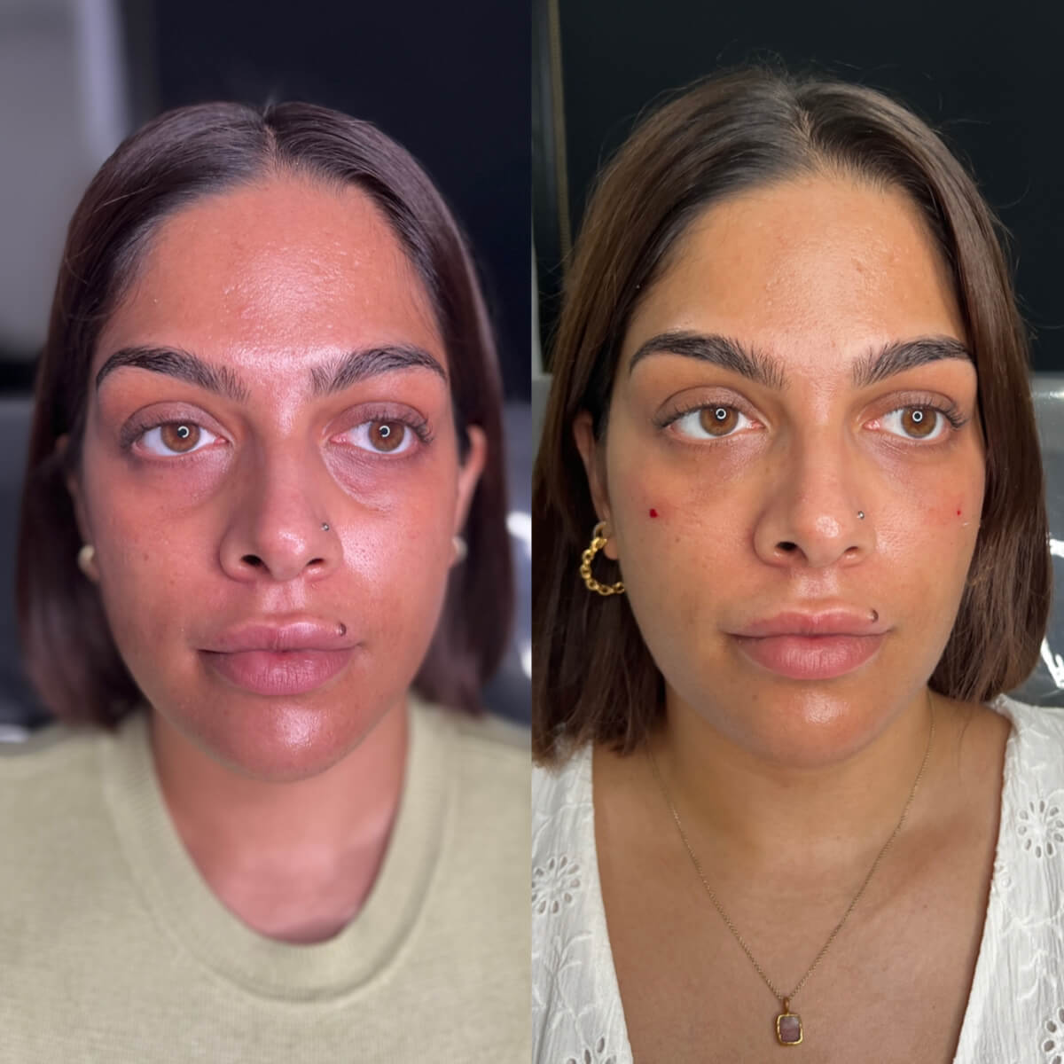 Tear Trough Fillers | Aesthetic Clinic in London