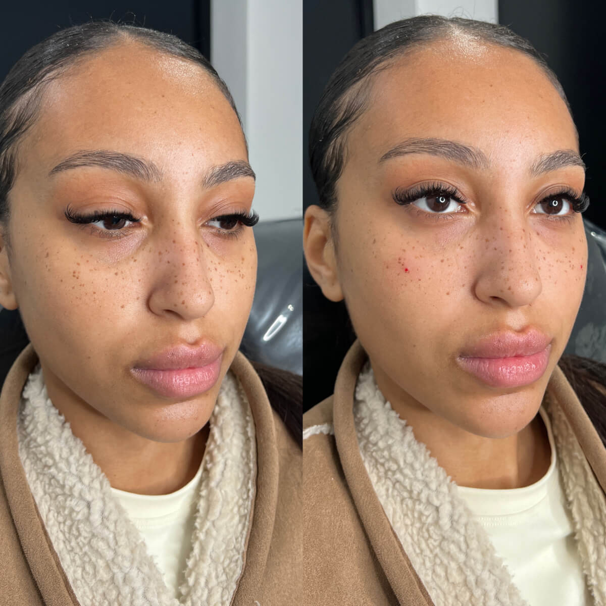 Tear Trough Fillers | Aesthetic Clinic in London