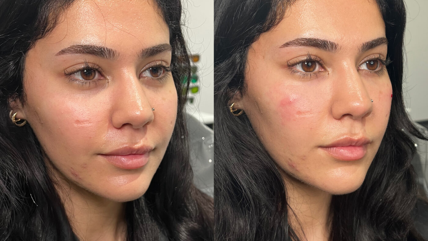 Tear Trough Fillers | Aesthetic Clinic in London
