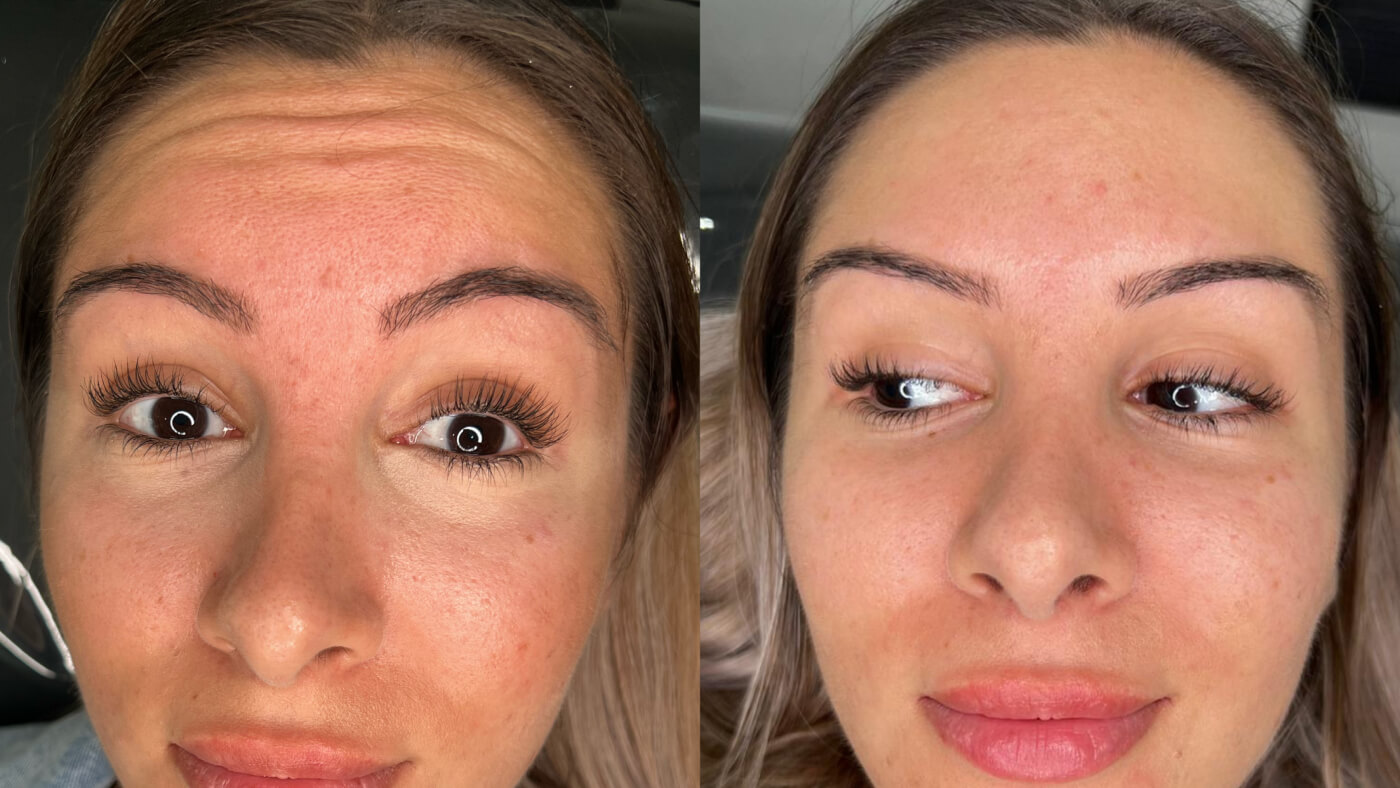 Forehead Lines | Forehead Botox | Faces By Bae