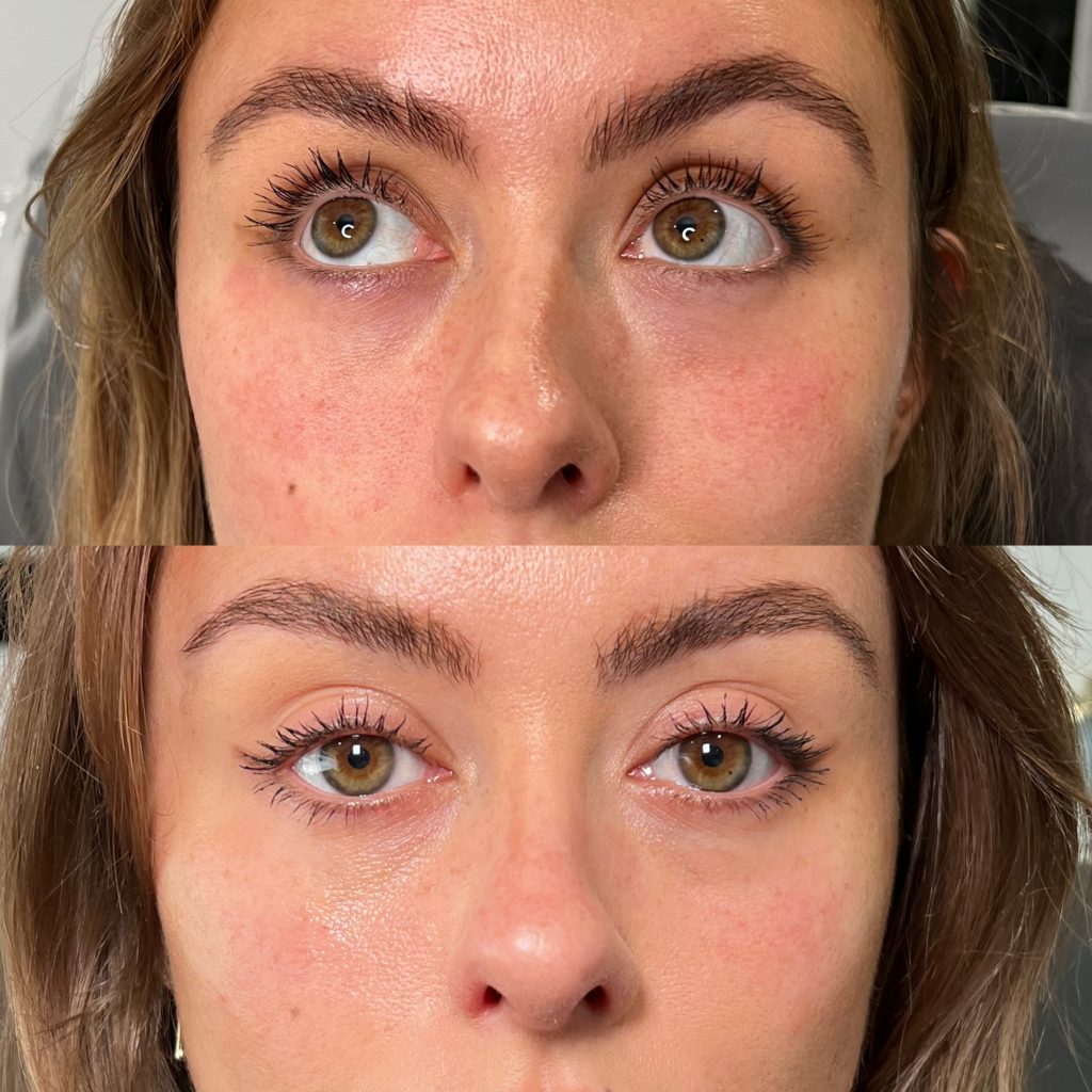 Masseter Jawline Slimming Botox - Faces By Bae