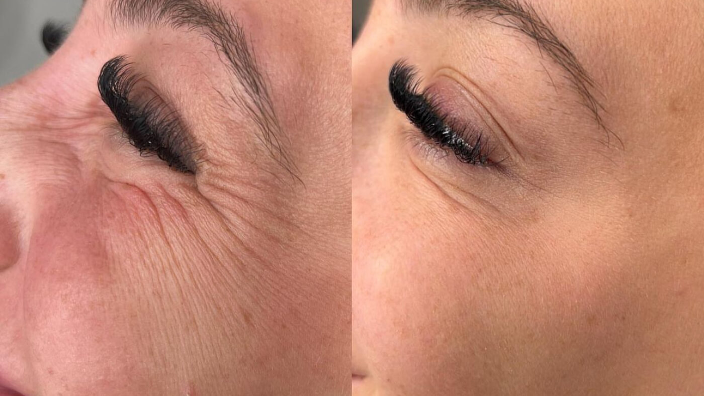 Crows Feet | Facial Treatments | Faces By Bae