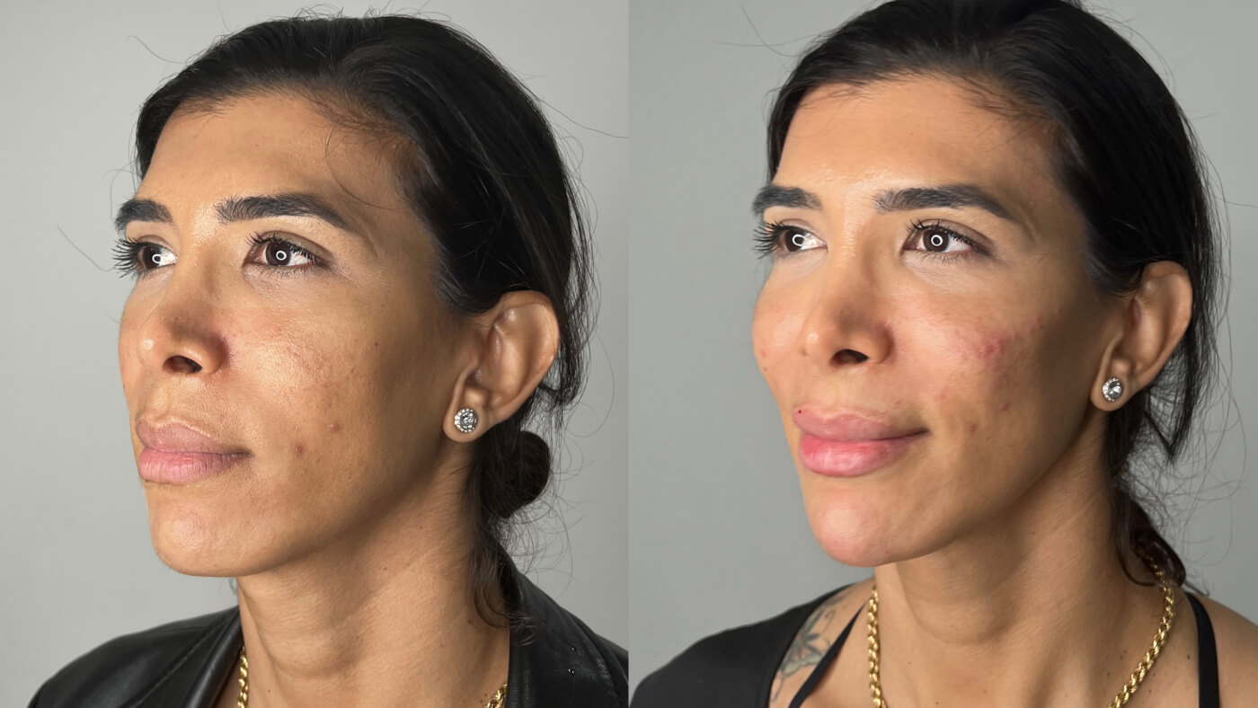 Dissolving Dermal Filler - Faces By Bae